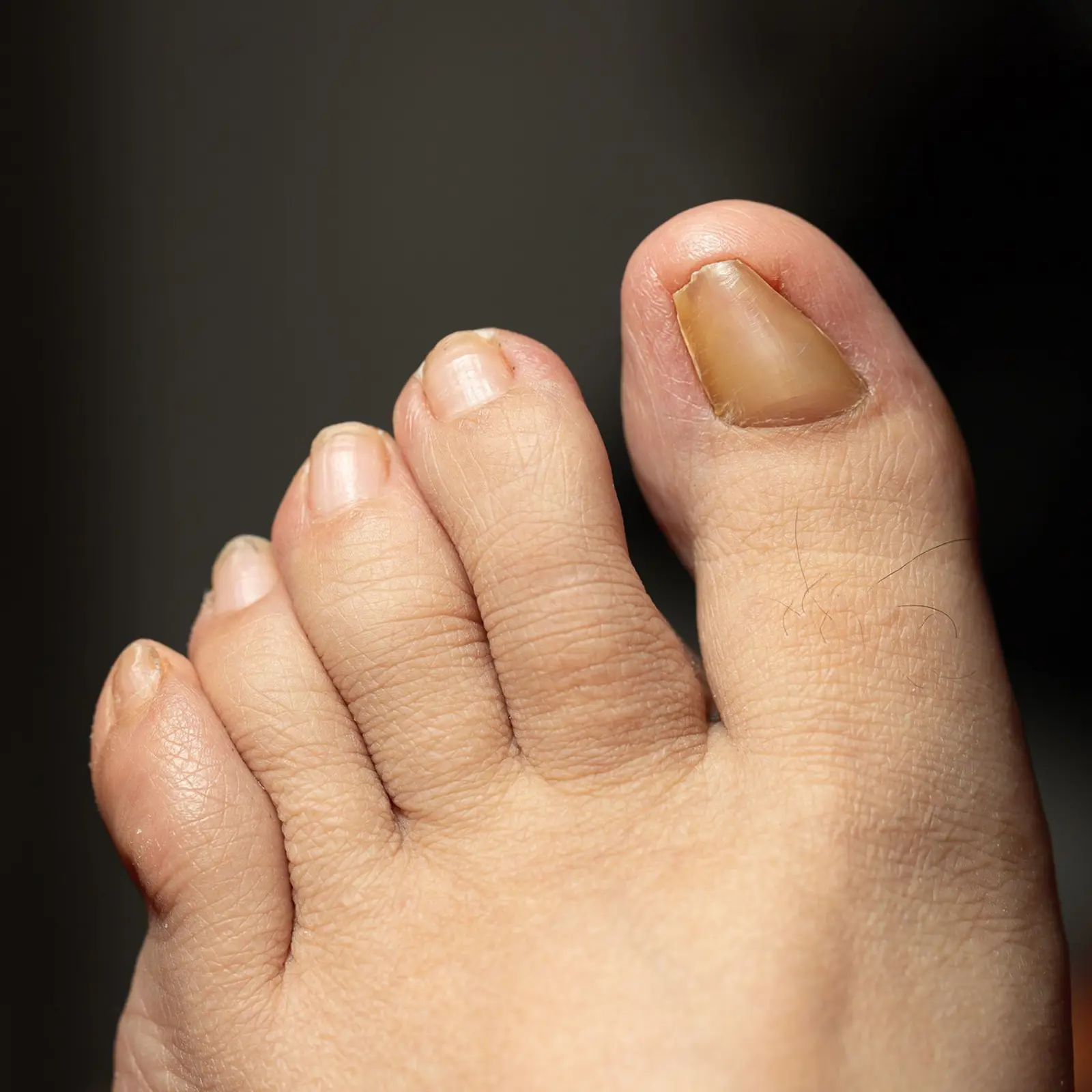 Ingrown Toenails | Teton Foot & Ankle Center | Idaho Falls