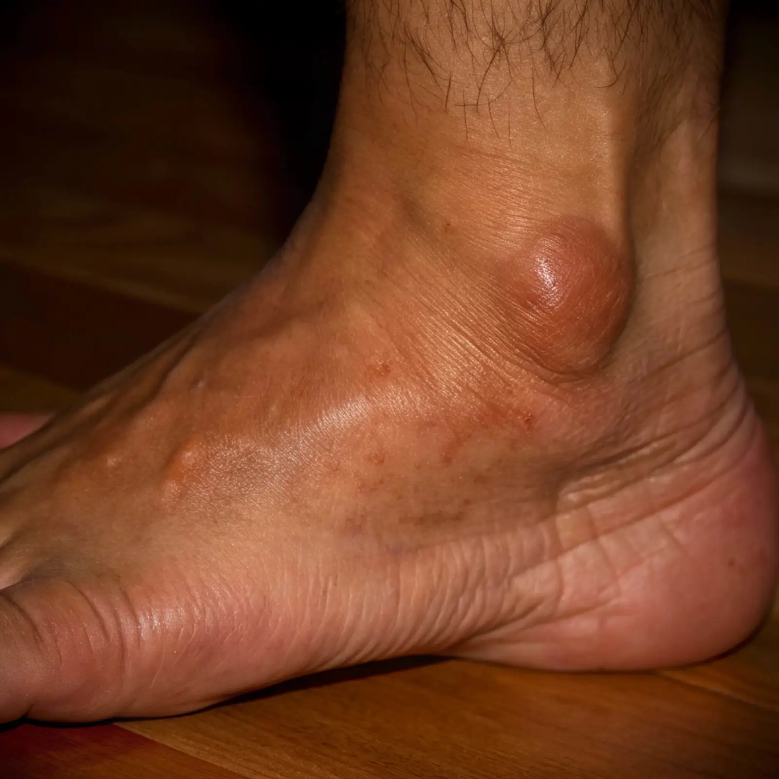Ganglion Cyst | Teton Foot & Ankle Center